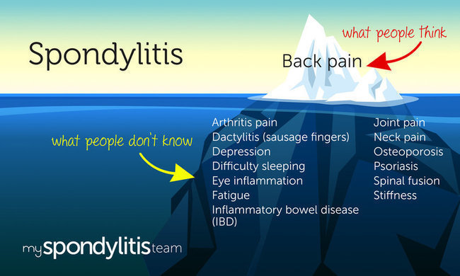 Spondylitis: What People Don't See (Infographic) | MySpondylitisTeam