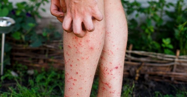 Skin Rashes Caused By Crohn’s Disease | MyCrohnsandColitisTeam