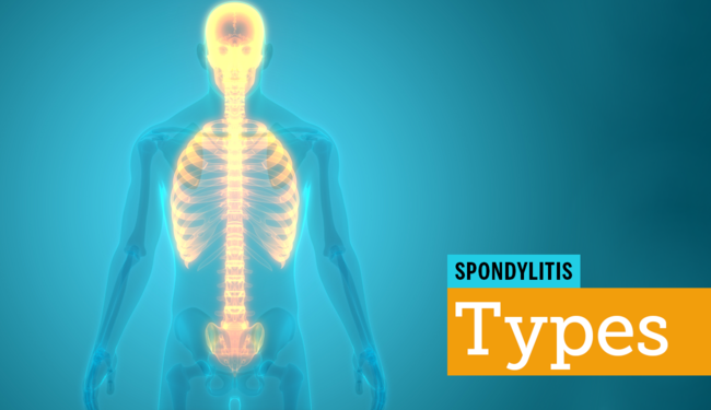 Spondylitis Types | MySpondylitisTeam